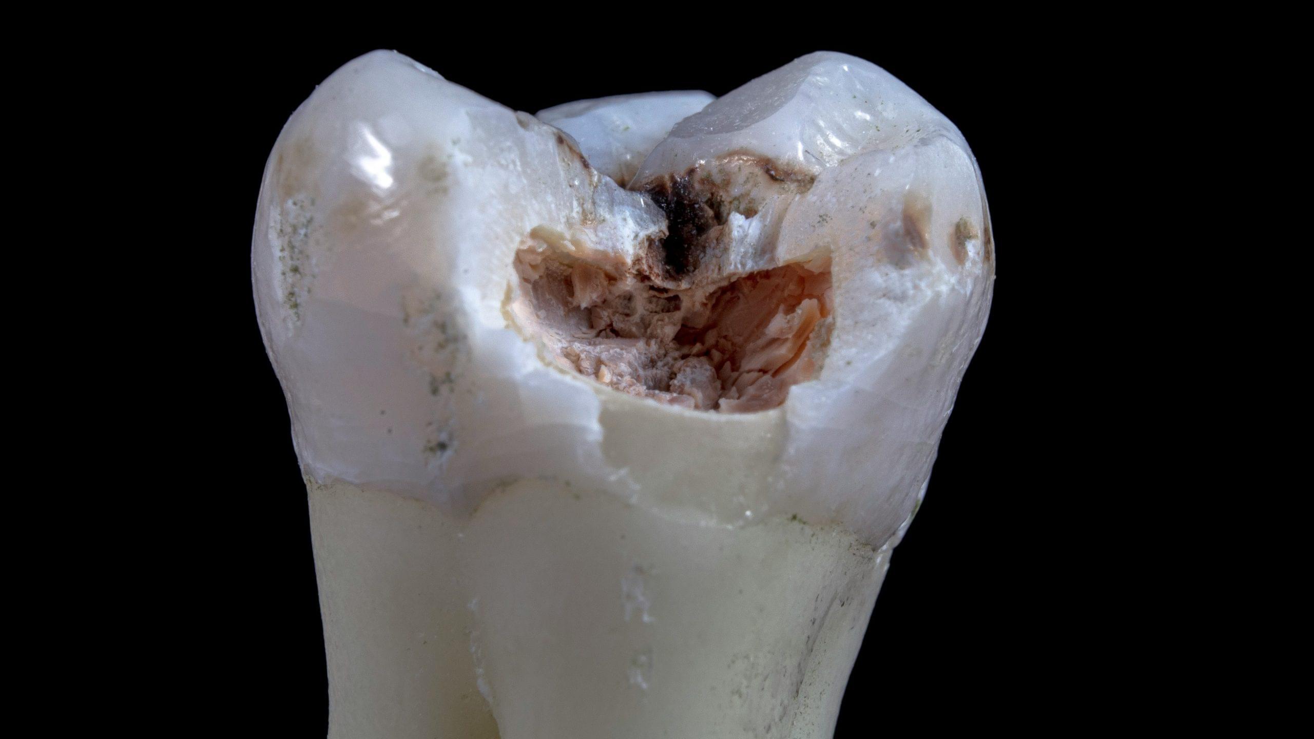 What Happens If Tooth Decay Is Left Untreated?